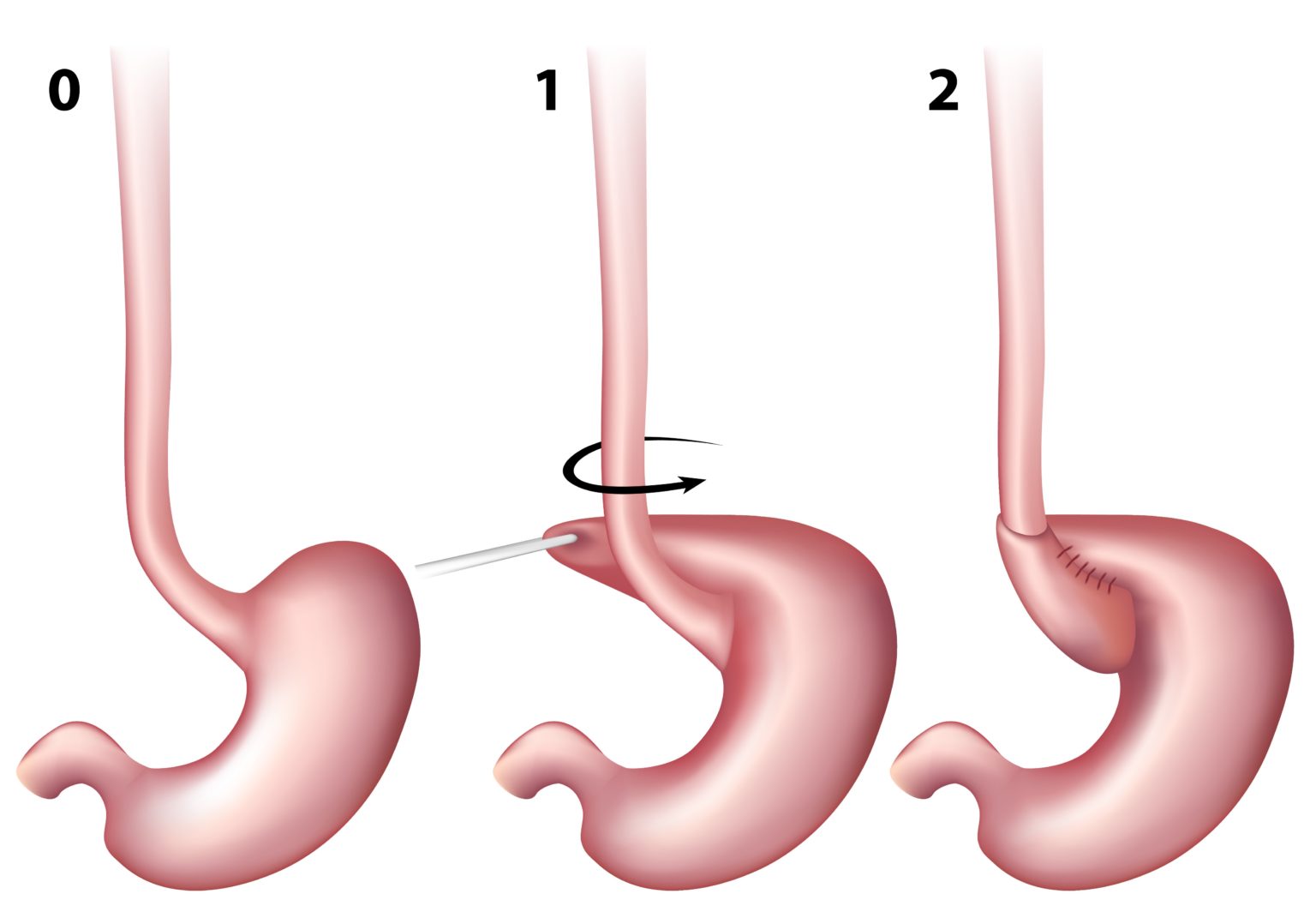 Stiller Reflux erklärt | Symptome, Behandlung, Ernährung